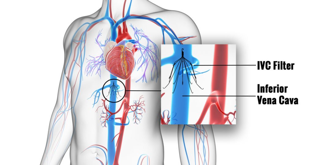 IVC Filter Lawsuit for Injury Claims – Settlement & Recall – High ...